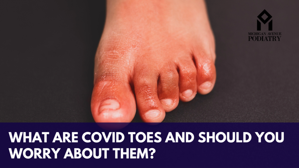 What Are COVID Toes And Should You Worry About Them?
