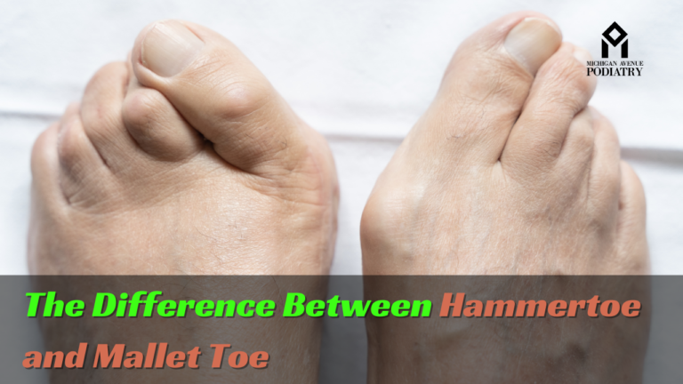 Hammertoe Surgery: Everything You Need To Know