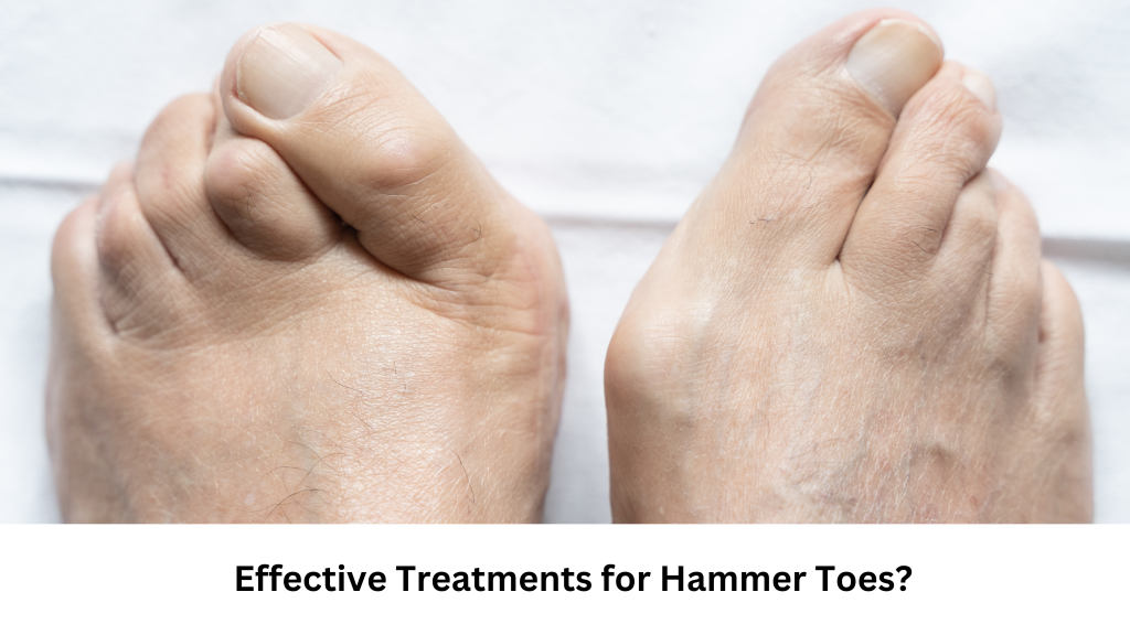 Mallet Toe Vs Hammer Toe: What's The Difference?