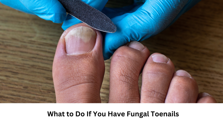 What To Do If You Have Fungal Toenails: Treatment Options And ...