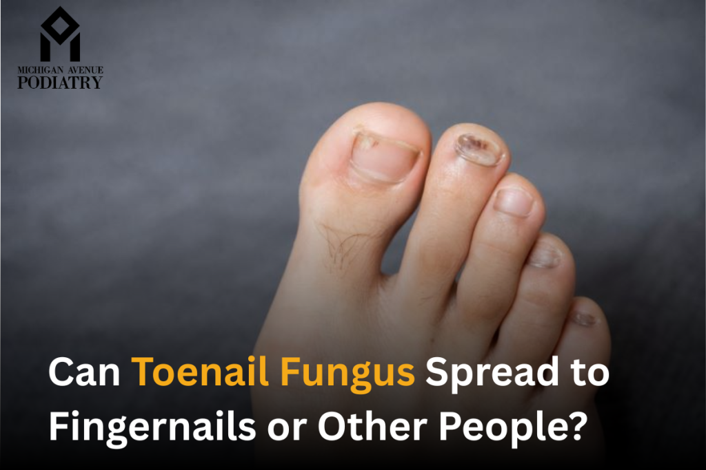 Can Toenail Fungus Spread? How To Stop It From Spreading